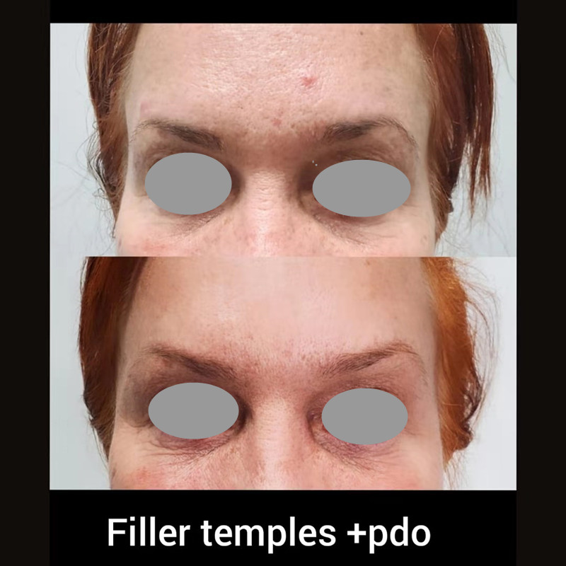 How to inject hyaluronic acid to make the forehead fuller? - Dermax