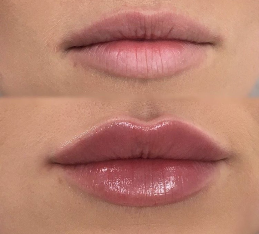 Hyaluronic Lip Filler Before and After Thin Lips: Real Results - Dermax