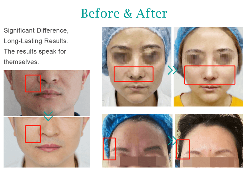 Treating Face with PLLA Poly-L-Lactic Acid: Facial Rejuvenation - Dermax
