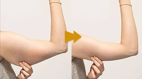 LipoGo™ Lipolytic Injections Before and After | Fat Reduction Results