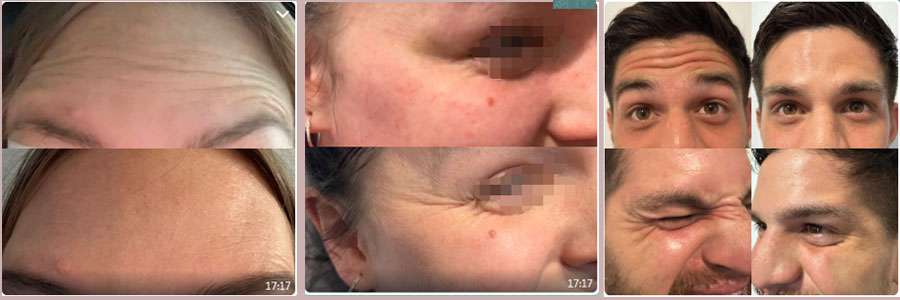 How Long Does It Take for Botulinum Toxin to Work? - Dermax