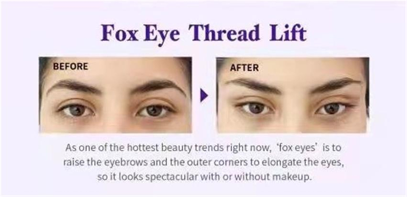 Pdo Thread Lift for Hooded Eyes, Buy Pdo Thread Lift for Hooded Eyes ... Pdo Thread Lift for Hooded Eyes, Buy Pdo Thread Lift for Hooded Eyes ...