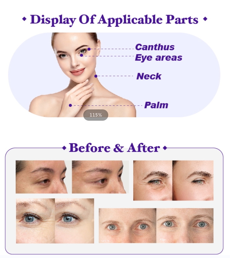 What Is Pdo Mono Threads - Dermax