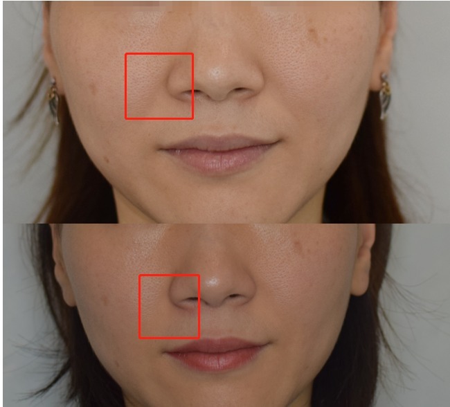 PLLA Filler Before and After: Remarkable Enhancements with Devolux - Dermax