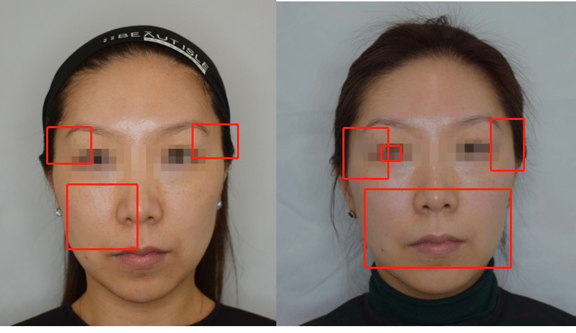 Devolux® Vital PLLA Filler Injection Before and After: What to Expect