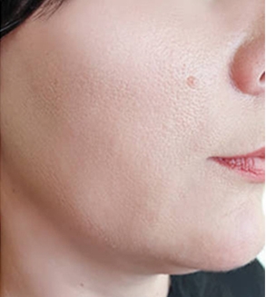 Explore Aqua Secret: Filler Cheeks Before And After - Dermax
