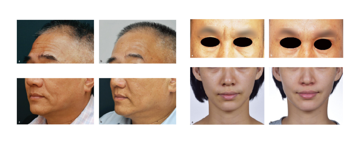 Skin Booster Injection: Hydrated & Youthful Skin - Dermax