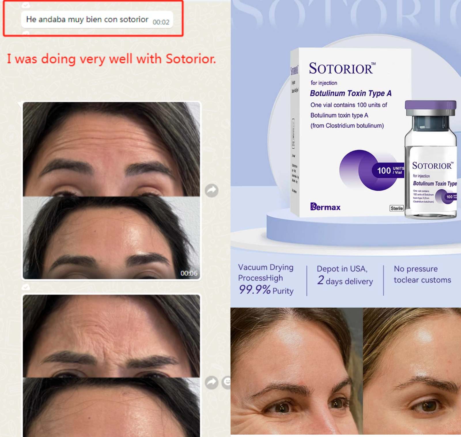 How Long Does It Take for Botulinum Toxin to Work? - Dermax