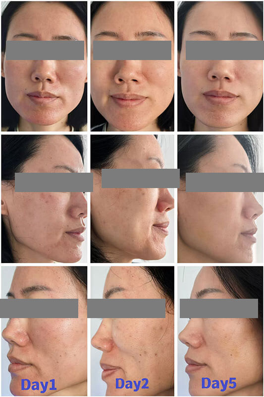 PDRN Injection Before And After: What You Need To Know - Dermax