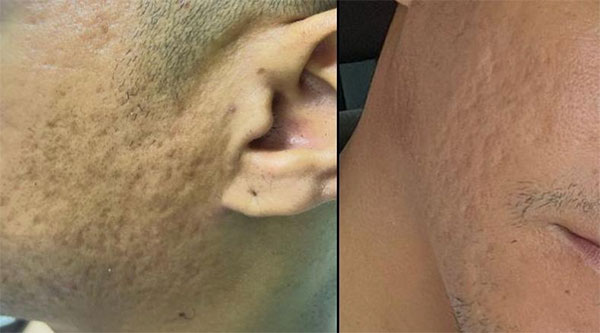 PDRN Injection Before And After: What You Need To Know - Dermax