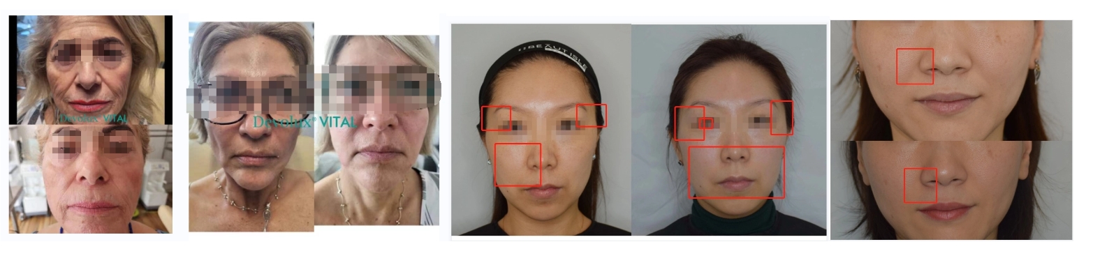 Devolux Plla Filler Injection Before And After - Dermax