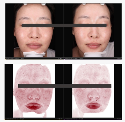 buy Polydeoxyribonucleotide PDRN Skin Injection - Dermax