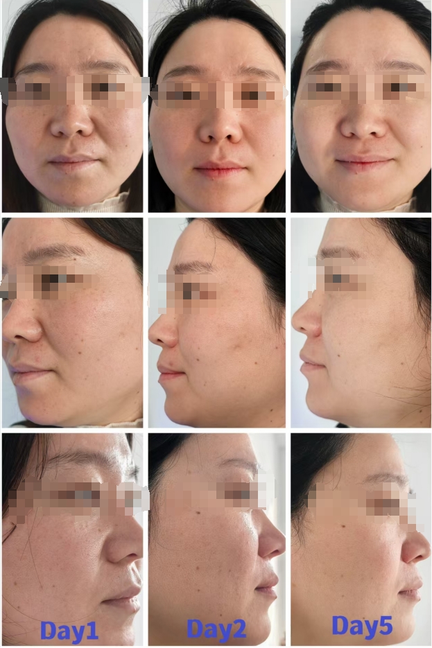 EXOBLOOM Exosome Injection For Face - Dermax