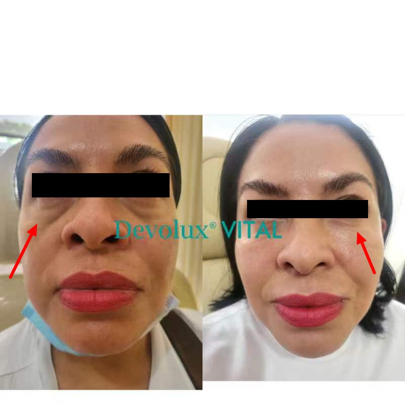 PLLA Filler Before and After: Remarkable Enhancements with Devolux - Dermax