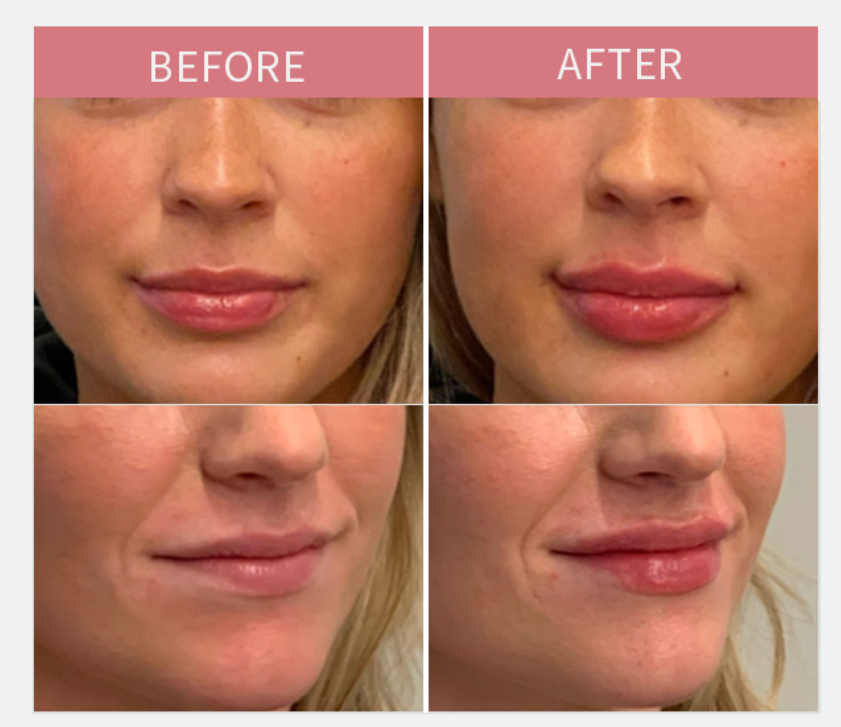 Aqua Secret 1ml Dermal Filler Lips Injection - Dermax