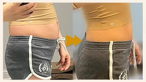 LipoGo™ Lipolytic Injections Before and After | Fat Reduction Results