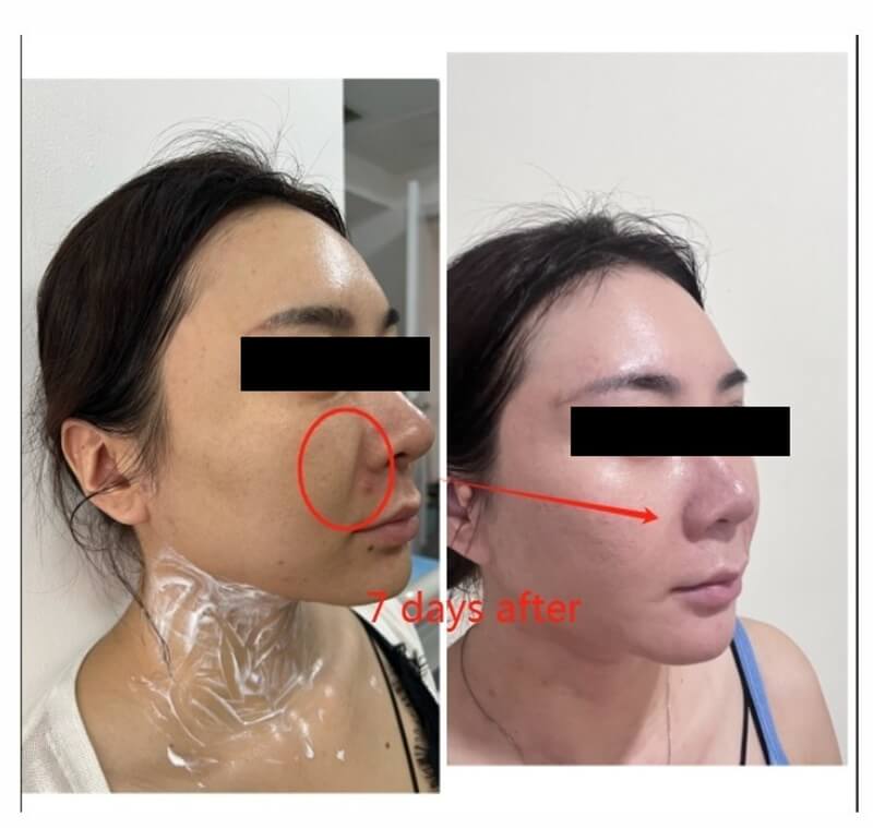 PrimeFill PMMA Injections Before & After Transformations - Dermax