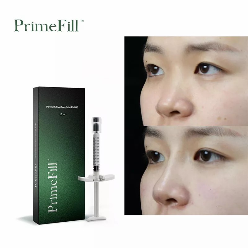 PrimeFill PMMA Injections Before & After Transformations - Dermax