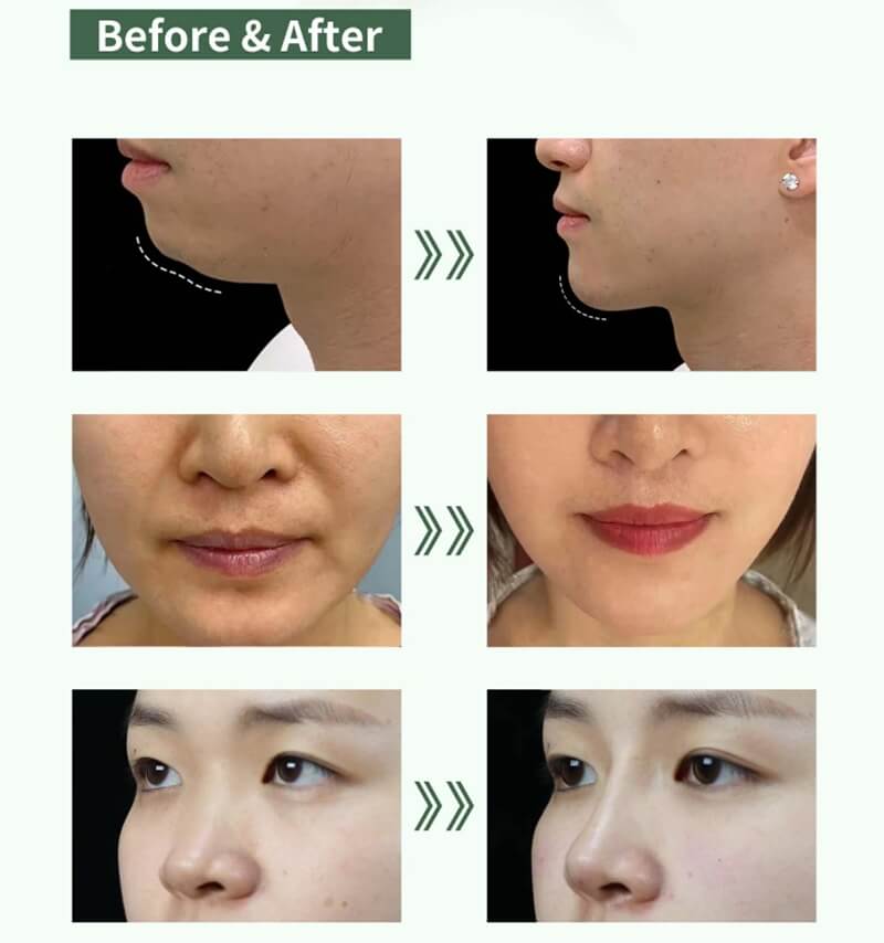 PrimeFill® PMMA Filler Reviews: What Real Users Say - Dermax