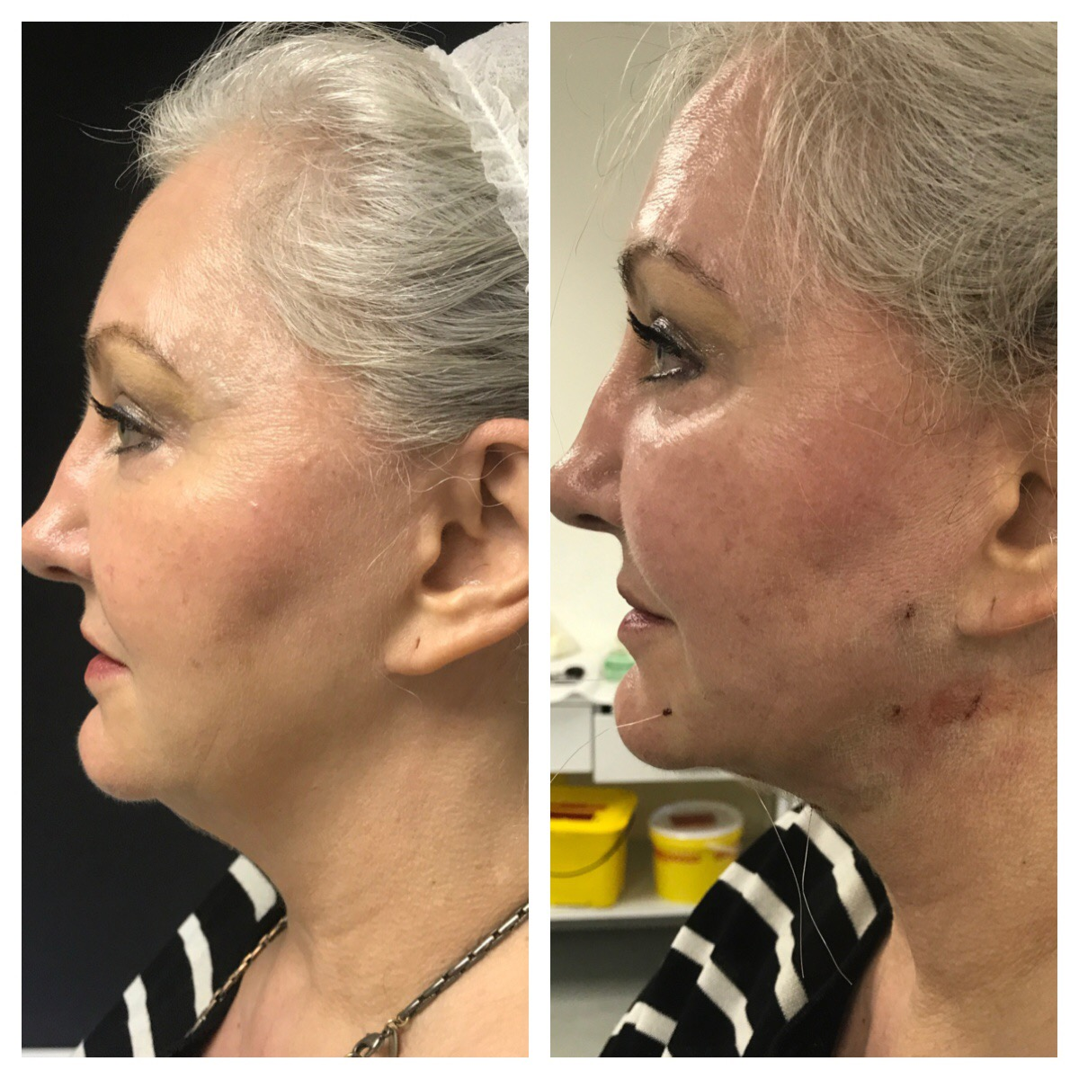 PDO Thread Lift: Double Chin Treatment Before And After Results - Dermax