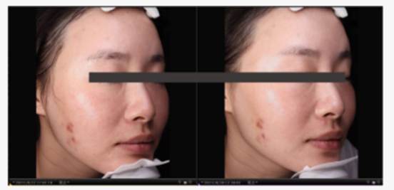 PDRN Injection Before And After: What You Need To Know - Dermax