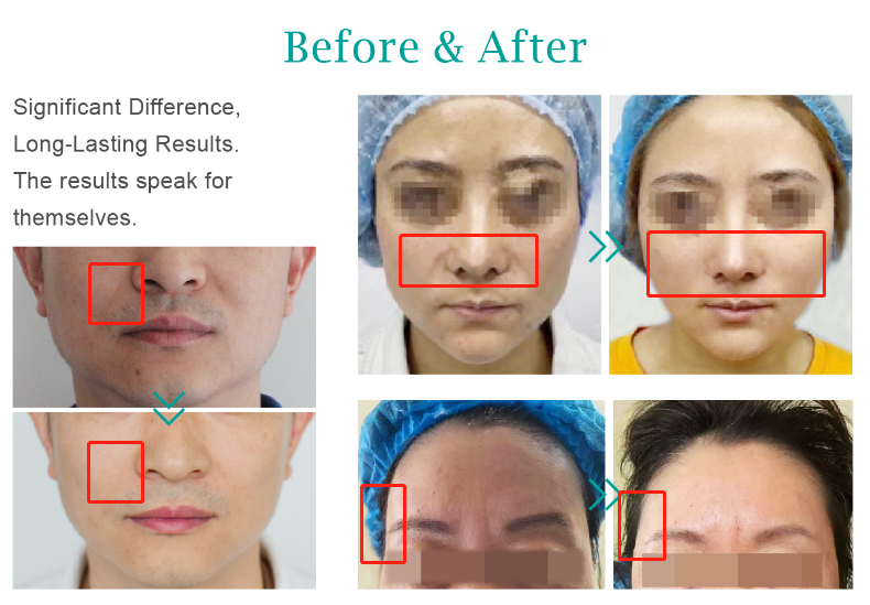 Treating Face with PLLA Poly-L-Lactic Acid: Facial Rejuvenation - Dermax