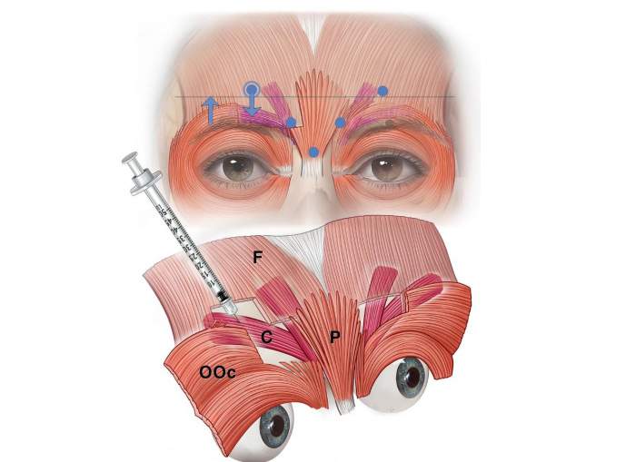 Best Areas for Botulinum Toxin Injections Ultimate Guide - Dermax