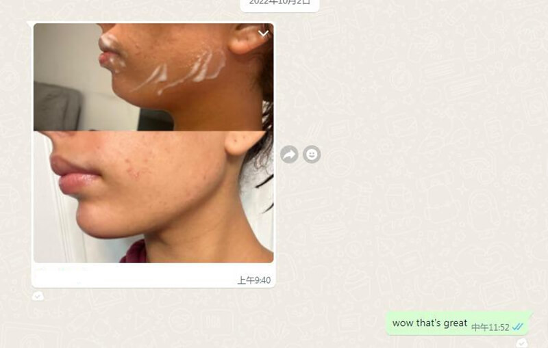 PrimeFill PMMA Injections Before & After Transformations - Dermax