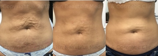 Pdo Thread Lift Abdomen - Dermax