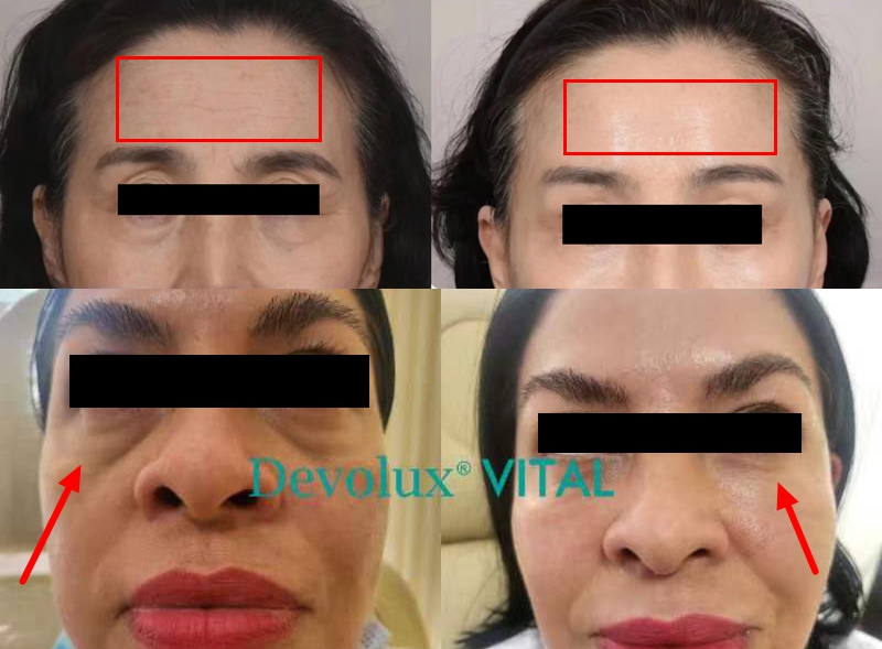 PLLA Face Before And After With Poly-L-Lactic Acid Dermal Filler - Dermax