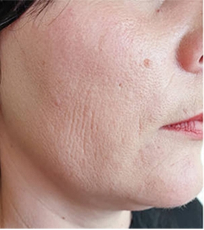 Explore Aqua Secret: Filler Cheeks Before And After - Dermax