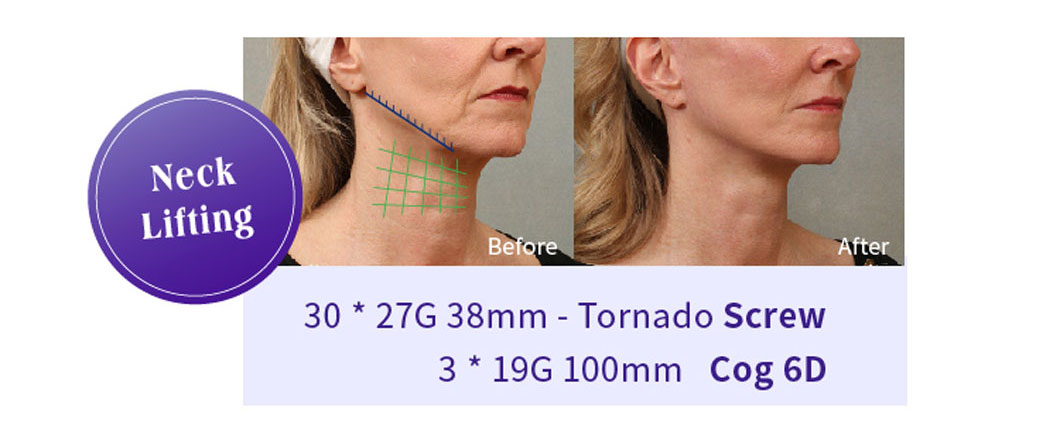 PDO Thread Neck Lift Before And After Comparison - Dermax