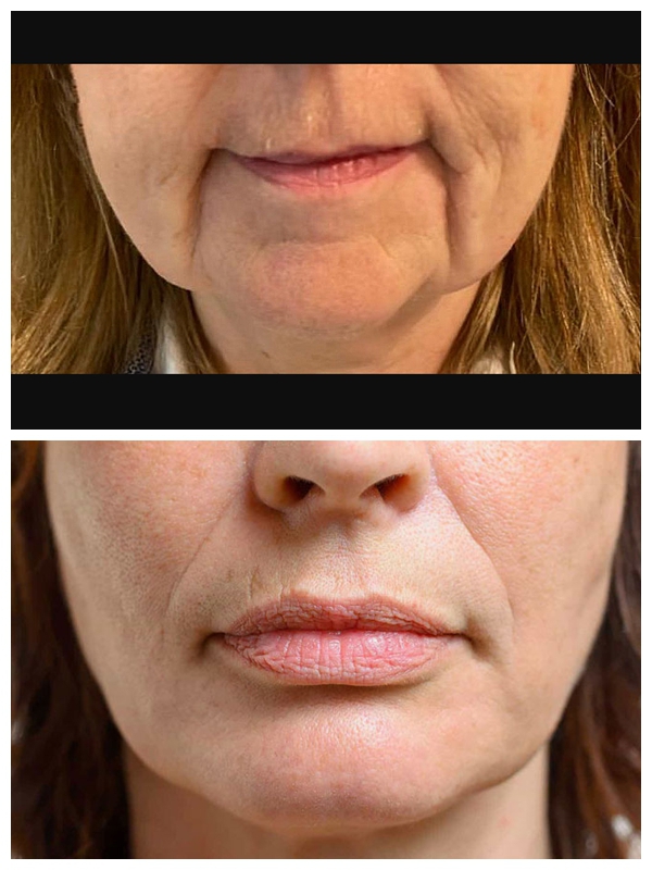 Biostimulator Injections Before and After: Botulinum, PLLA, and PDO Threads