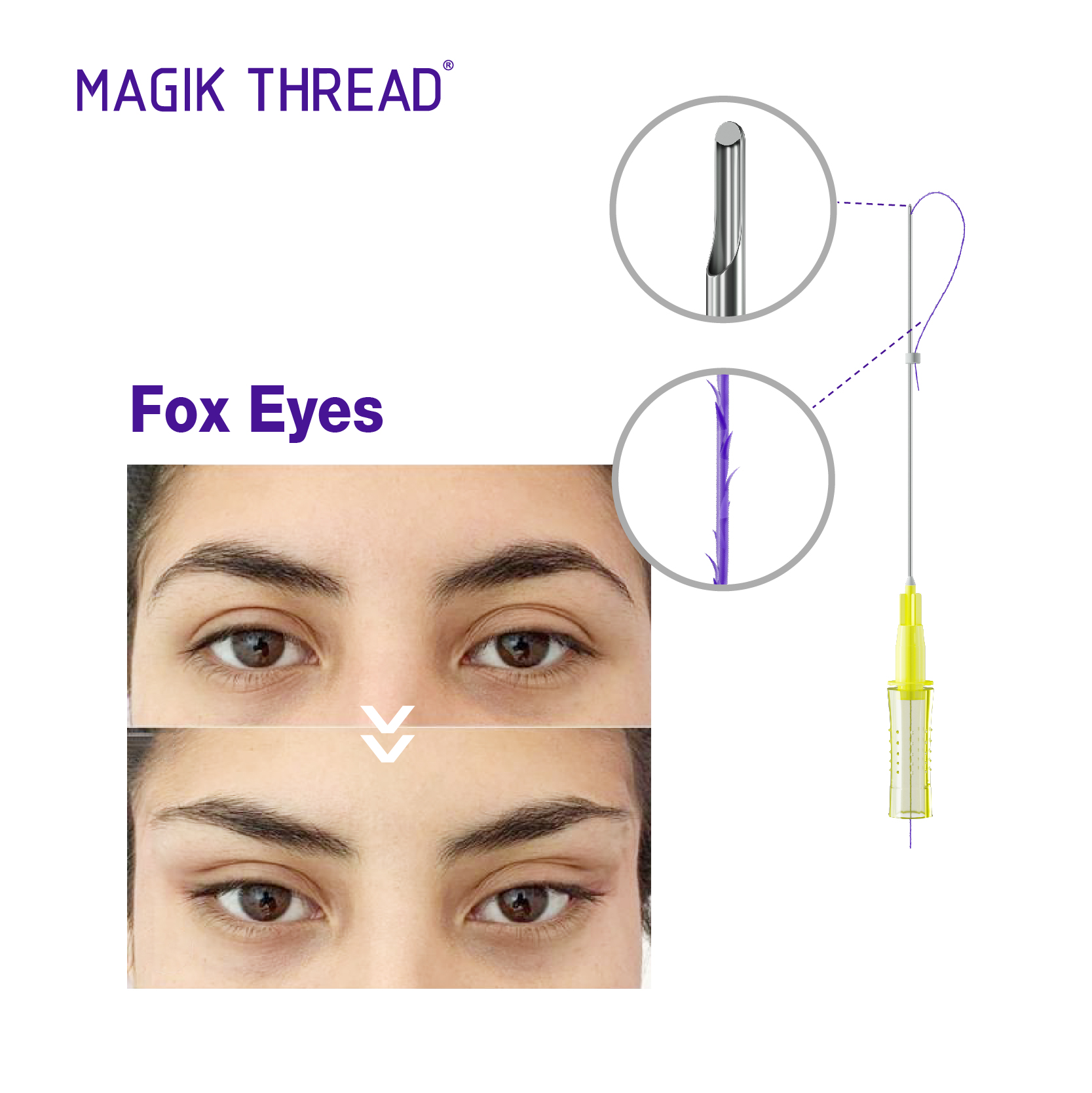 Magik Thread Fox Eyes Pdo Thread Lift - Dermax