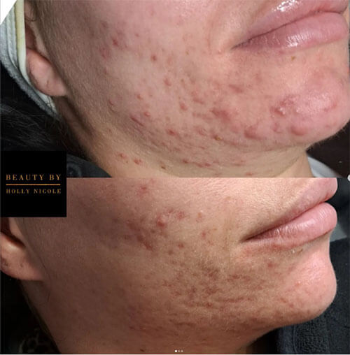 PDRN Injection Before And After: What You Need To Know - Dermax