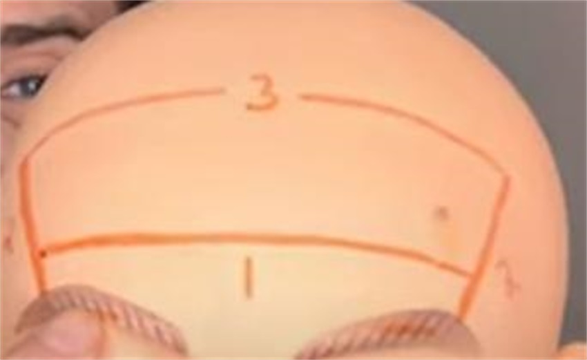 the botulinum toxin for forehead wrinkles - Dermax