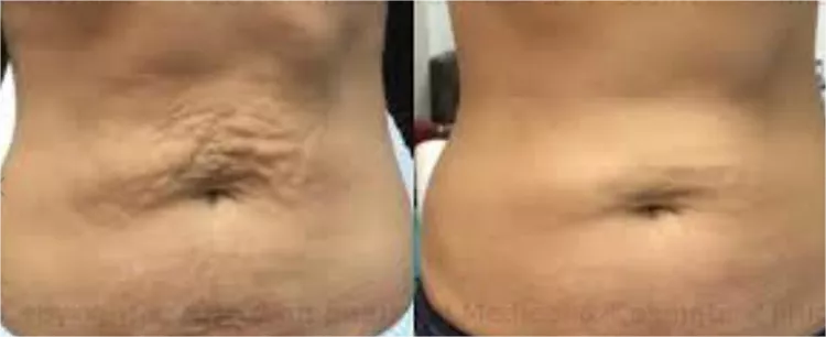 Before And After Pdo Thread Lift Abdomen - Dermax