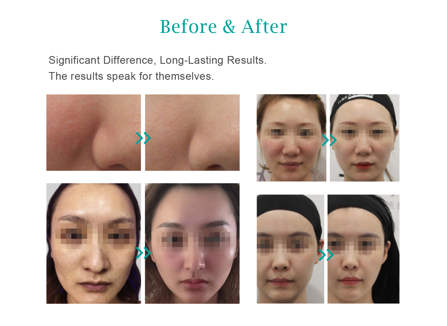 Best Korean Plla Filler Injections For Sale - Dermax Aesthetic