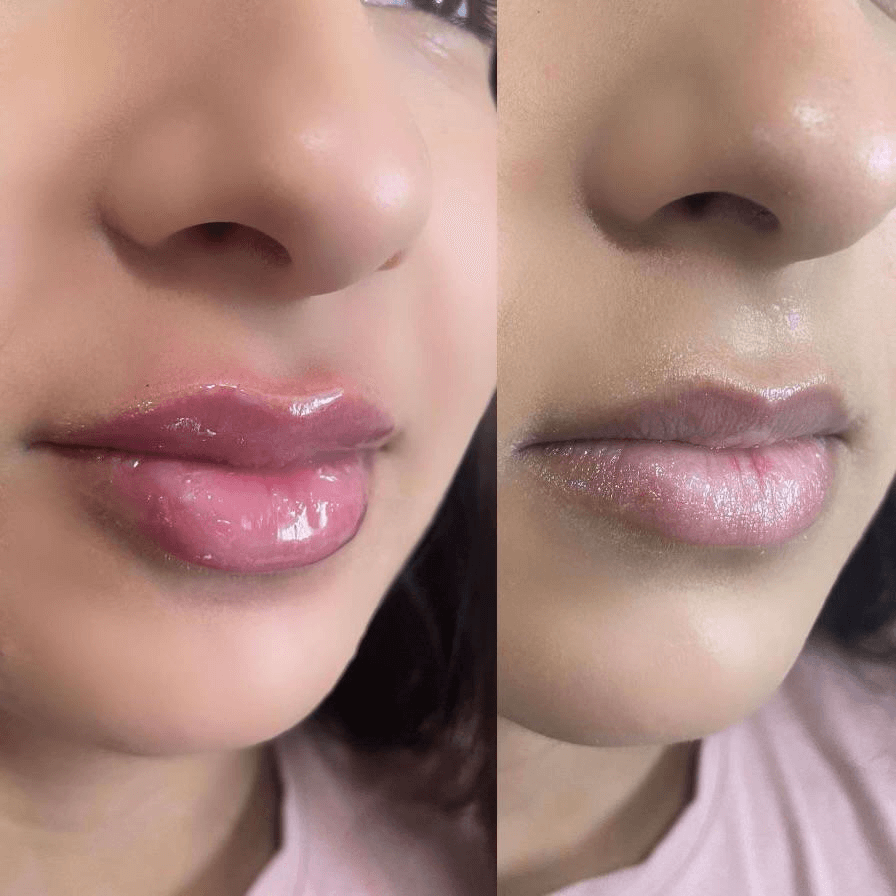 1ml Lip Filler Before and After Photos Stunning Transformations - Dermax