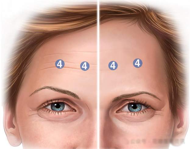 Best Areas for Botulinum Toxin Injections Ultimate Guide - Dermax