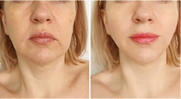 Magik Thread Pdo Thread Before And After - Dermax