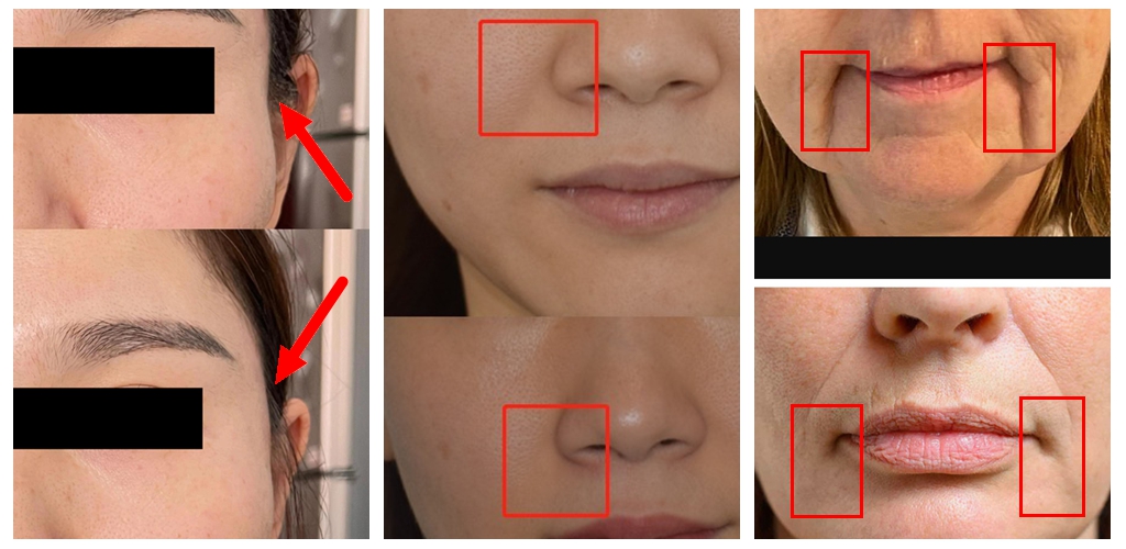 PLLA Face Before And After With Poly-L-Lactic Acid Dermal Filler - Dermax
