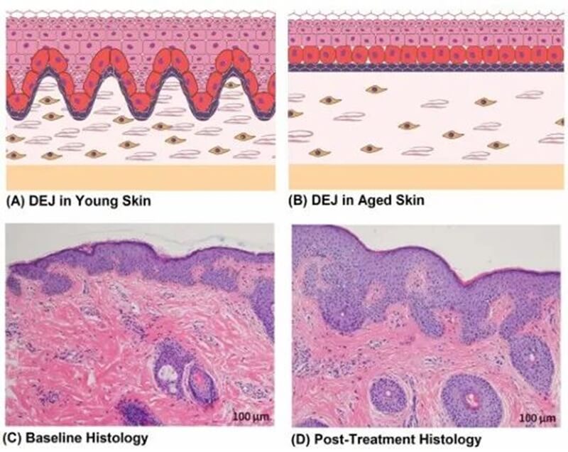 Microneedling with Exosomes: Restoring Epidermal Vitality - Dermax