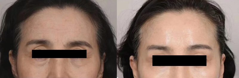 PrimeFill PMMA Injections Before & After Transformations - Dermax