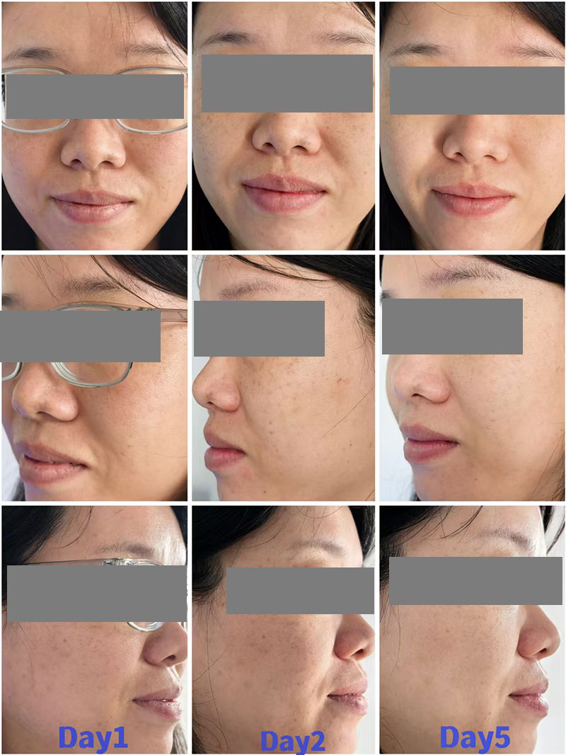 Mesocel Mesotherapy Before And After: Transforming Skin Naturally - Dermax