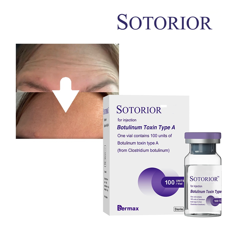 Biostimulator Injections Before and After: Botulinum, PLLA, and PDO Threads