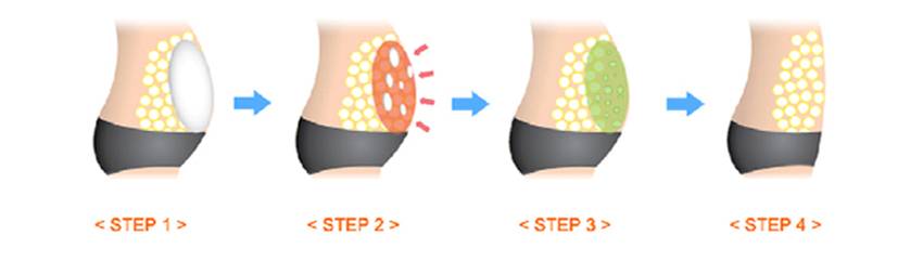 Mesolipo injection, mesotherapy fat removal - Dermax