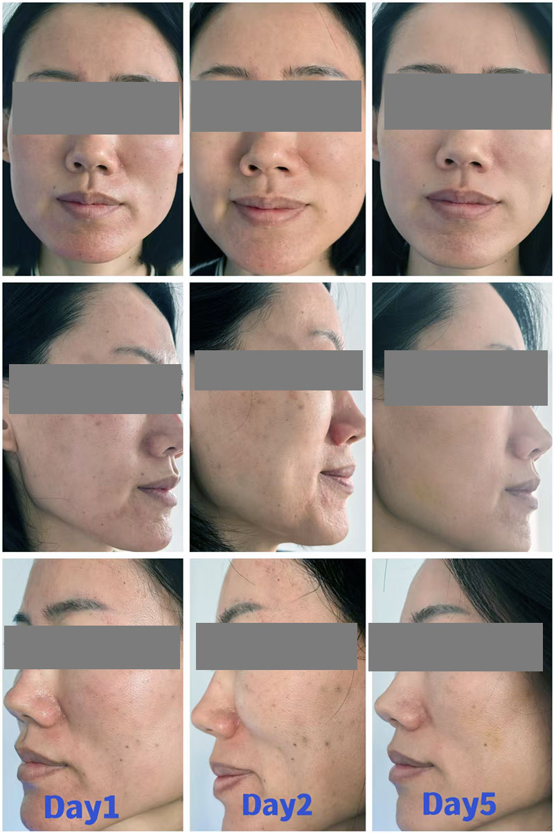 What Is Mesotherapy for Face? - Dermax