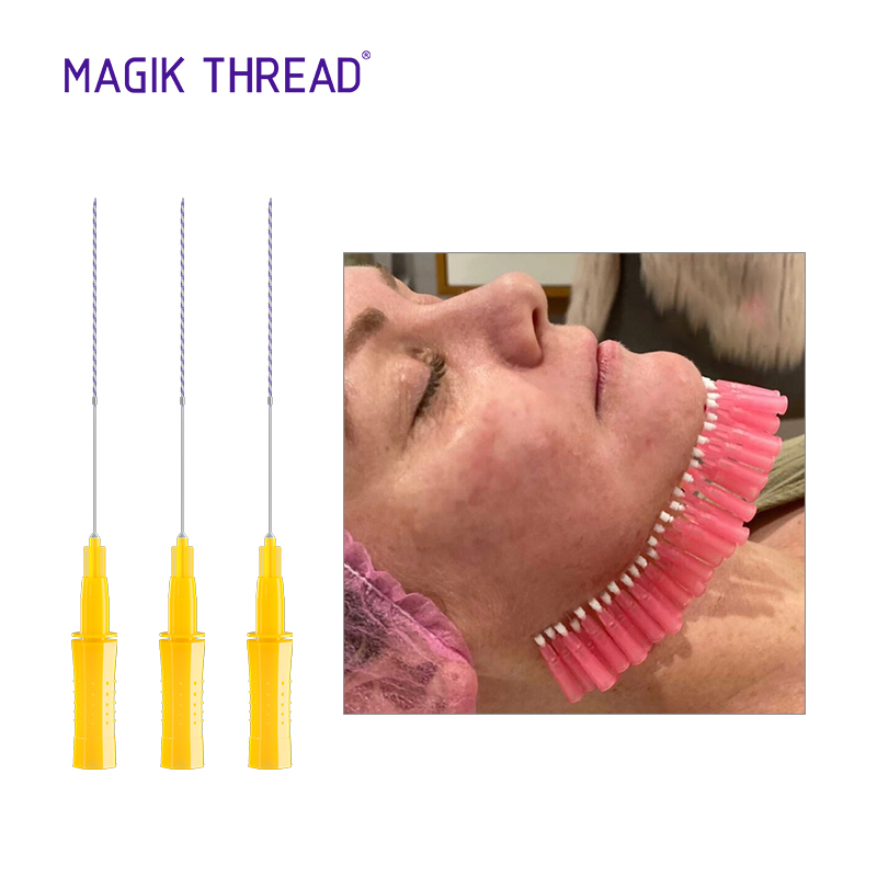PDO Thread Lift: Double Chin Treatment Before And After Results - Dermax