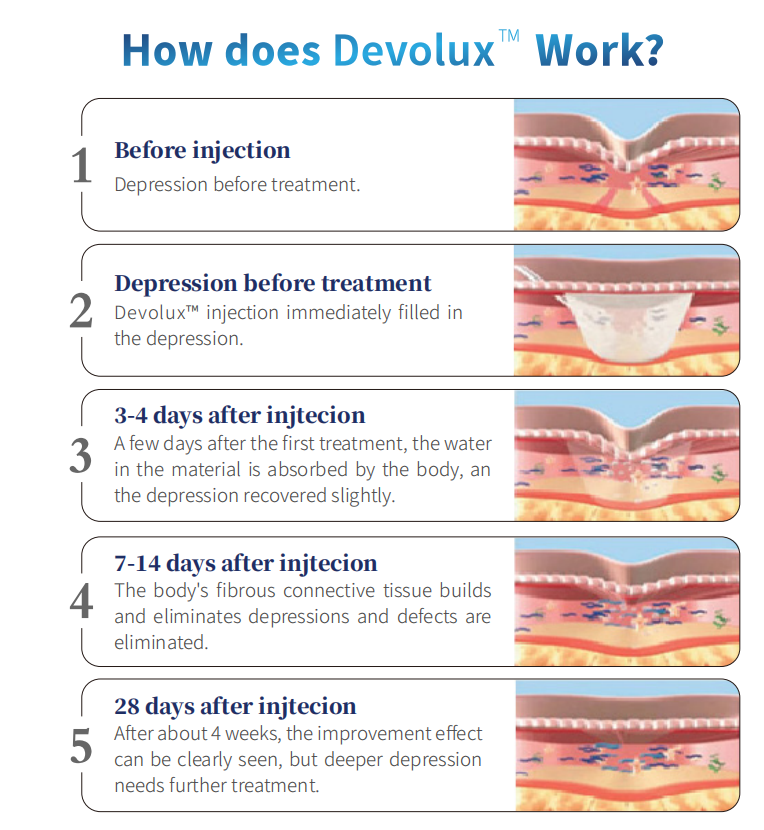 Mesotherapy PLLA Collagen Stimulator Explained - Dermax